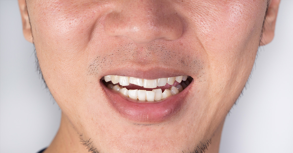 How to Deal with a Broken Tooth or Filling | Eagleby Dental